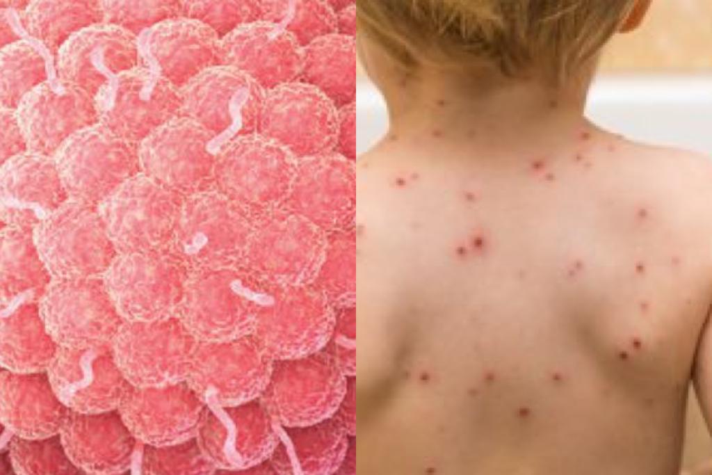 Kaitan sindrom Ramsay Hunt, virus cacar air dan kayap - Relevan