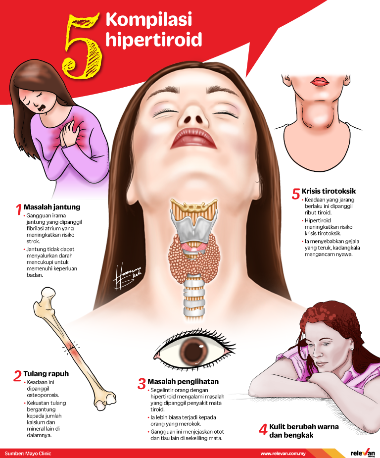 Apa itu hipertiroid, simptom dan faktor risiko - Relevan